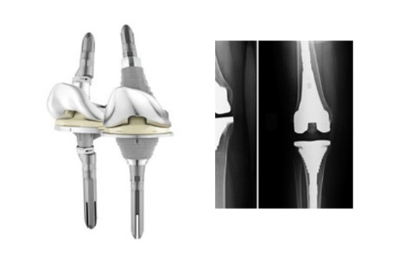 DePuy Synthes – Third Wave Systems
